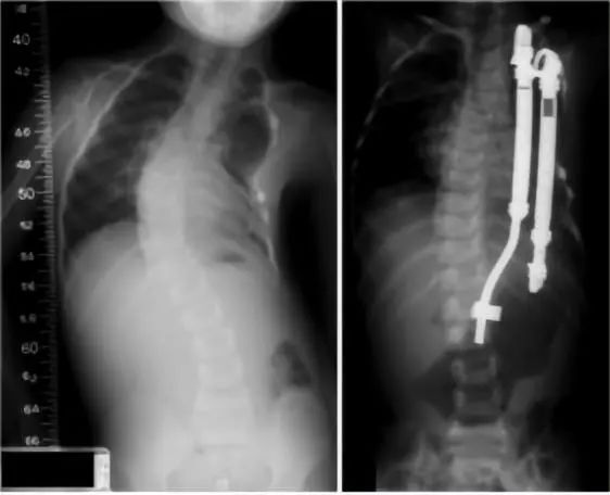 《Journal of Neurosurgery-Spine》2018年12月文章速览 - 脑医汇