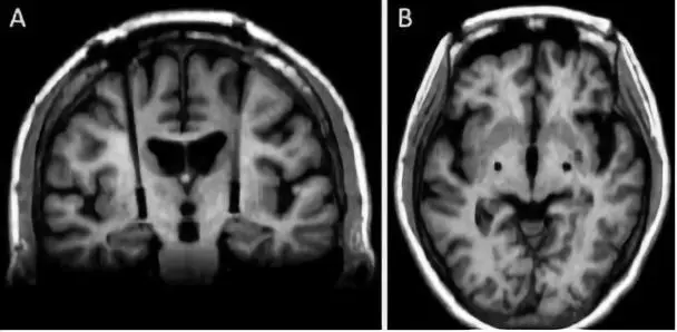DBS治疗Meige综合征的长期疗效 - 脑医汇