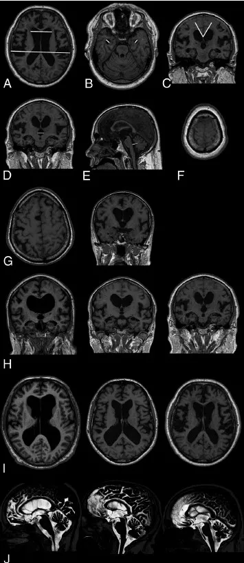 目前无特征性MRI标志可用于预测iNPH患者分流手术的疗效 - 脑医汇