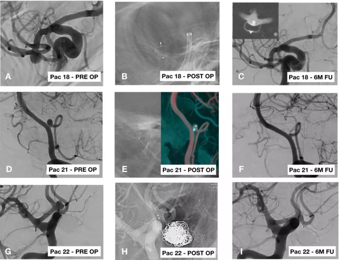 瘤内扰流新武器——第五代WEB支架的安全性和有效性研究 - 脑医汇