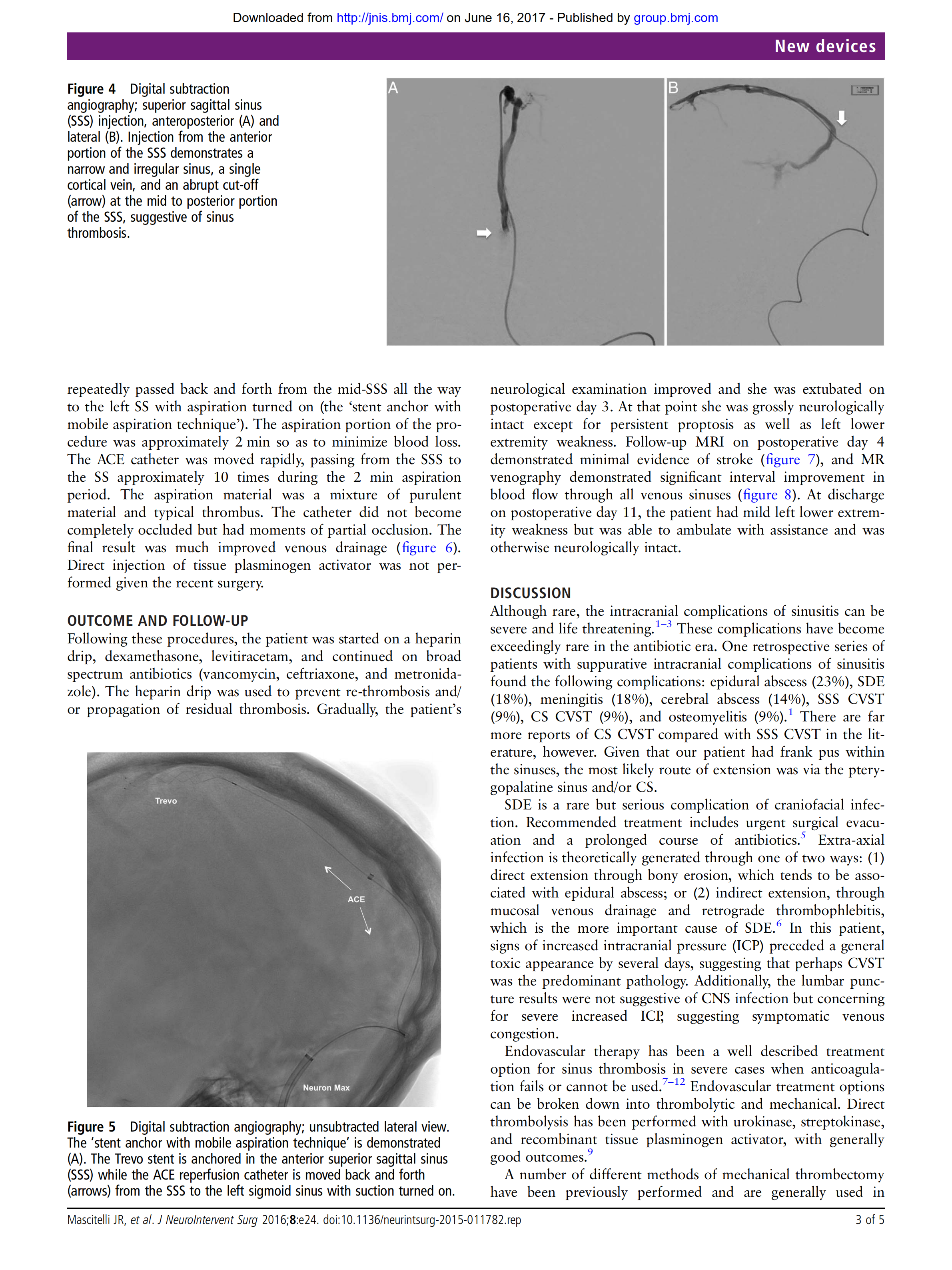 Venous Sinus Thrombectomy Using ACE and Trevo case report - Mascitelli ...