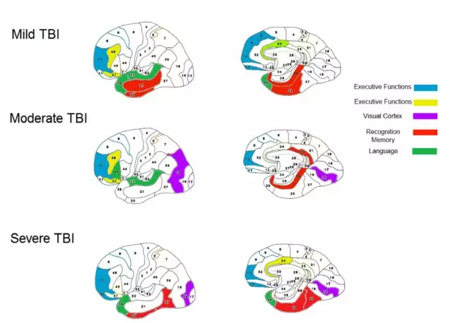 高压氧治疗改善TBI患者的慢性神经认知功能 - 脑医汇