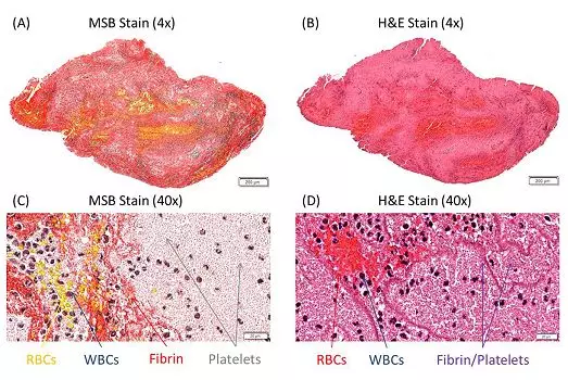 MSB染色的富血小板血栓在平扫CT上呈等密度影 - 脑医汇