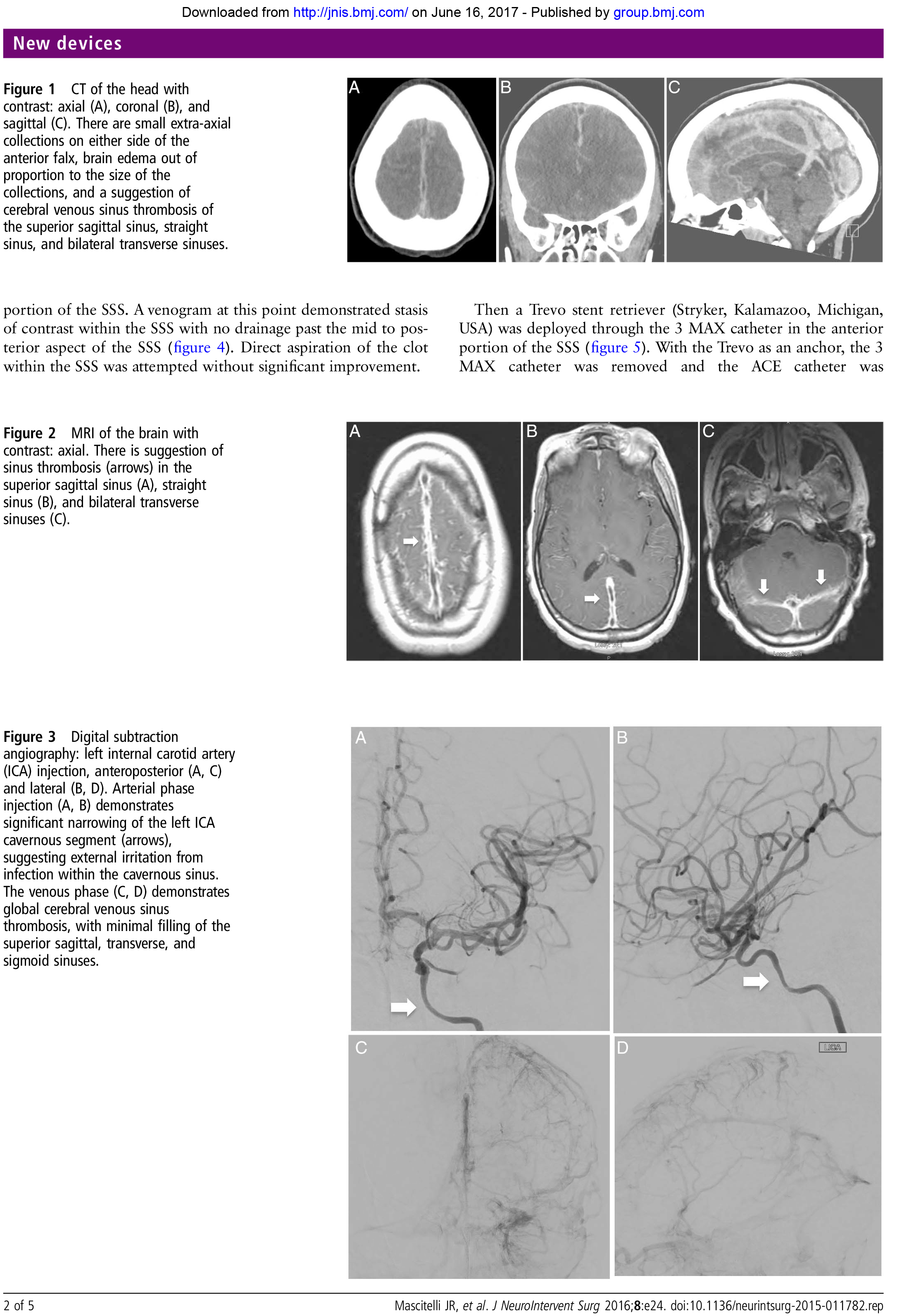 Venous Sinus Thrombectomy Using ACE and Trevo case report - Mascitelli ...