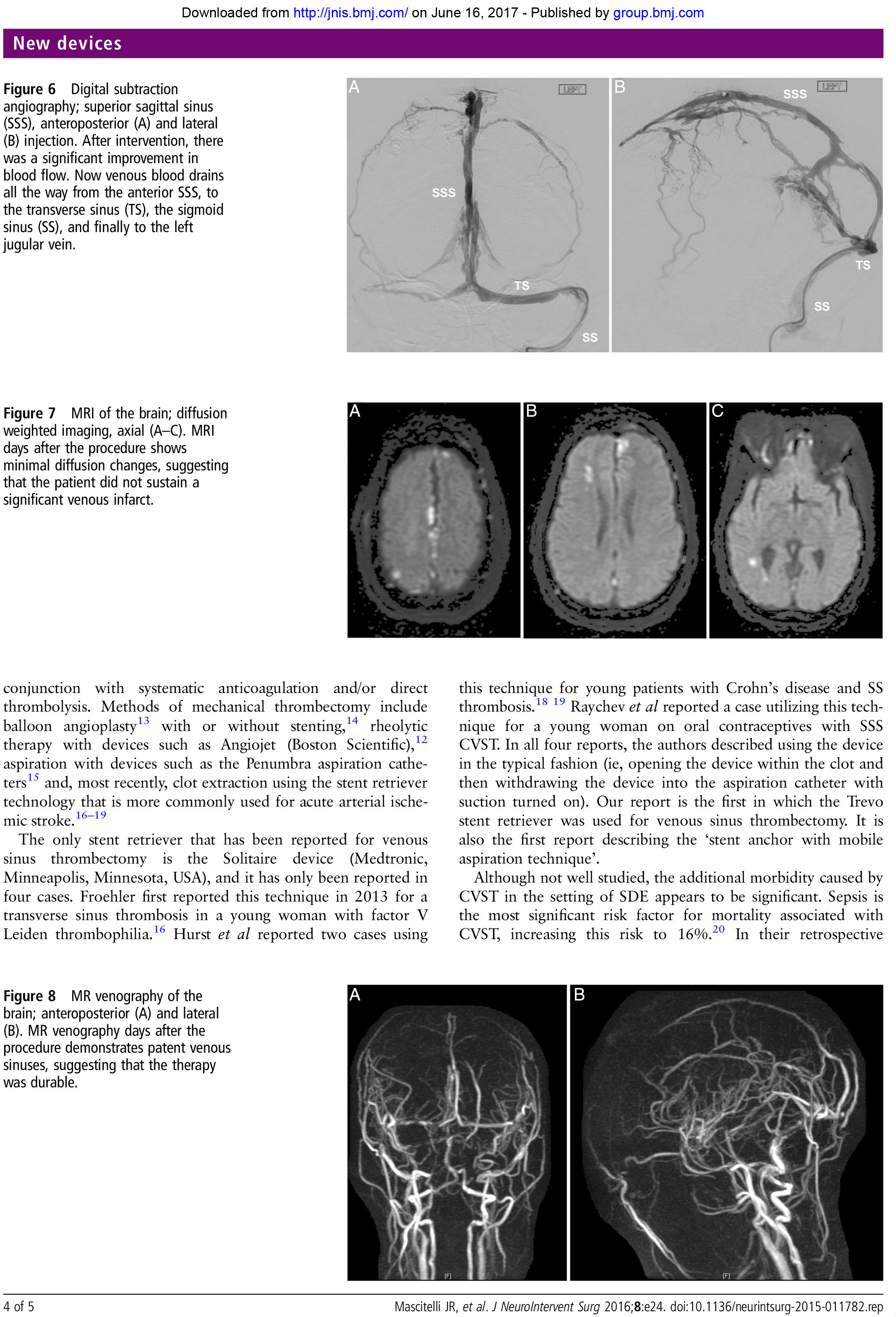 Venous Sinus Thrombectomy Using ACE and Trevo case report - Mascitelli ...