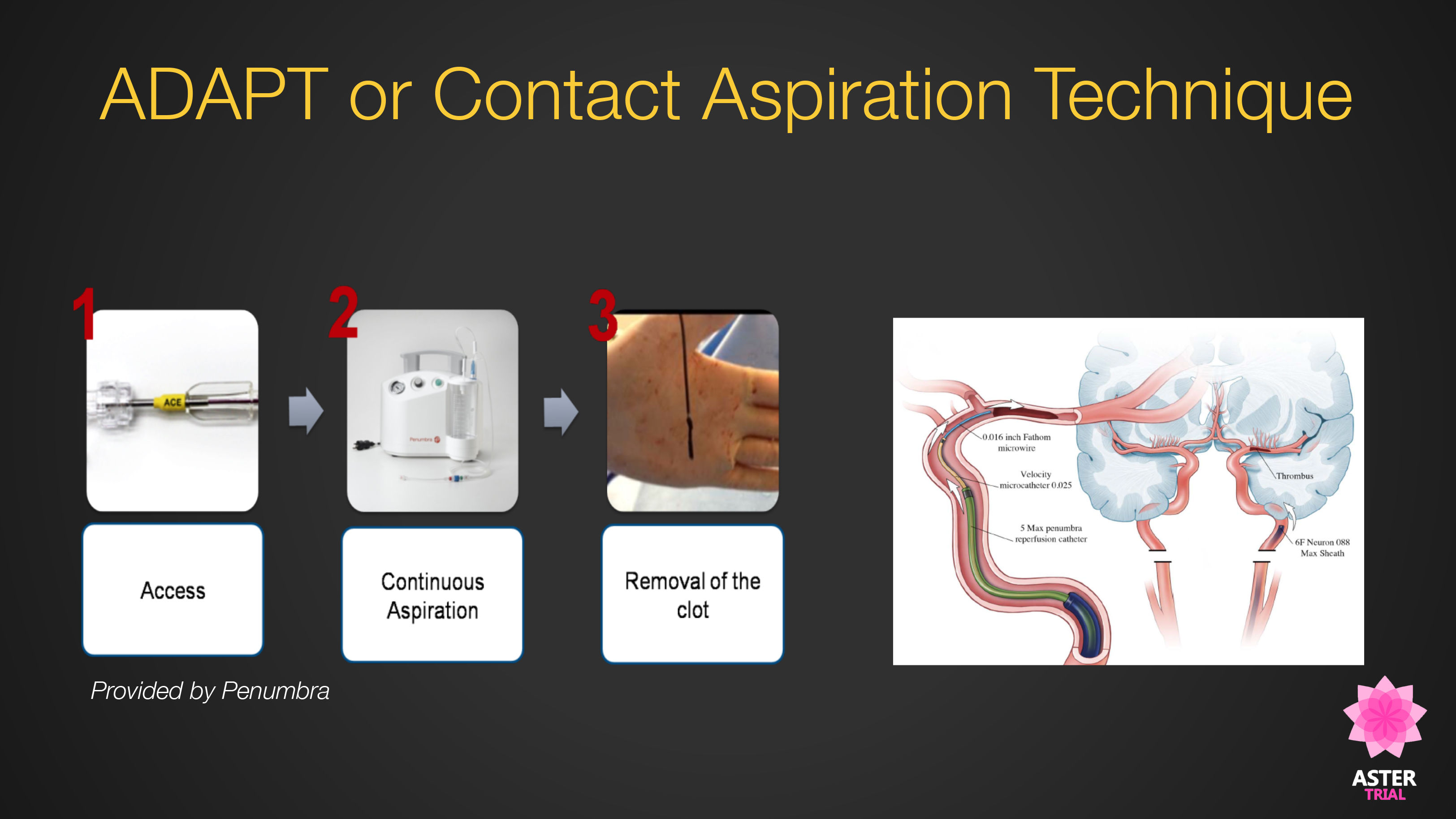 ASTER Presentation - 2017May ESOC - 脑医汇