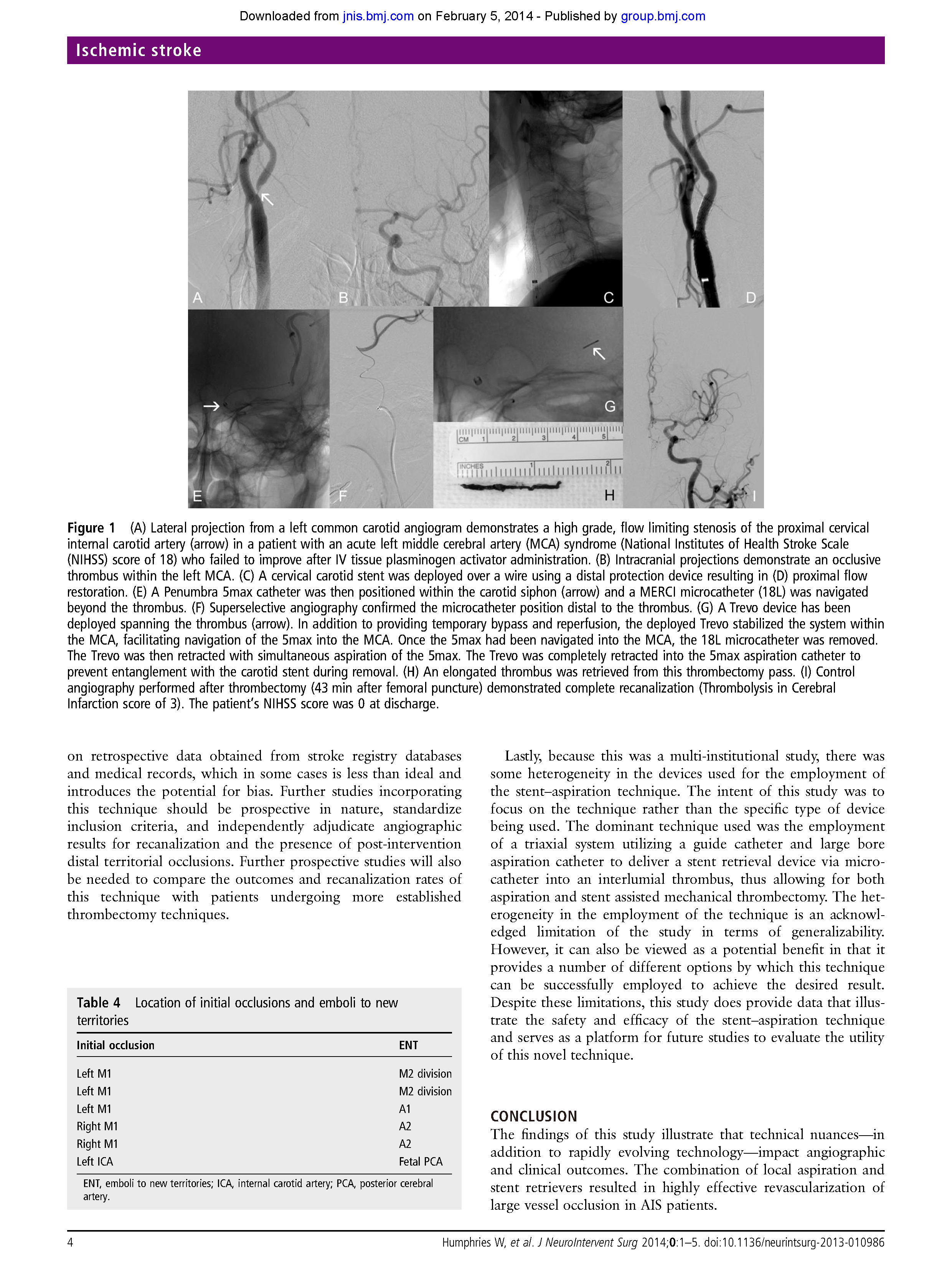 Distal aspiration with retrievable stent assisted thrombectomy for the ...