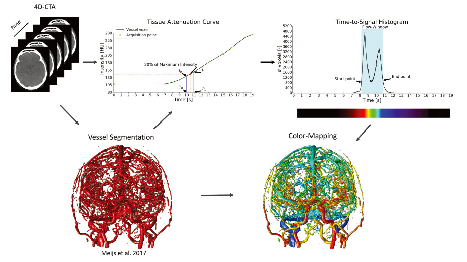 4D-CTA彩色成像检测脑动静脉分流 - 脑医汇
