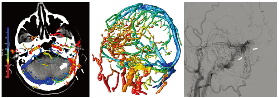 4D-CTA彩色成像检测脑动静脉分流 - 脑医汇