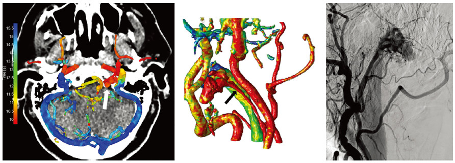 4D-CTA彩色成像检测脑动静脉分流 - 脑医汇