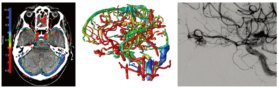 4D-CTA彩色成像检测脑动静脉分流 - 脑医汇