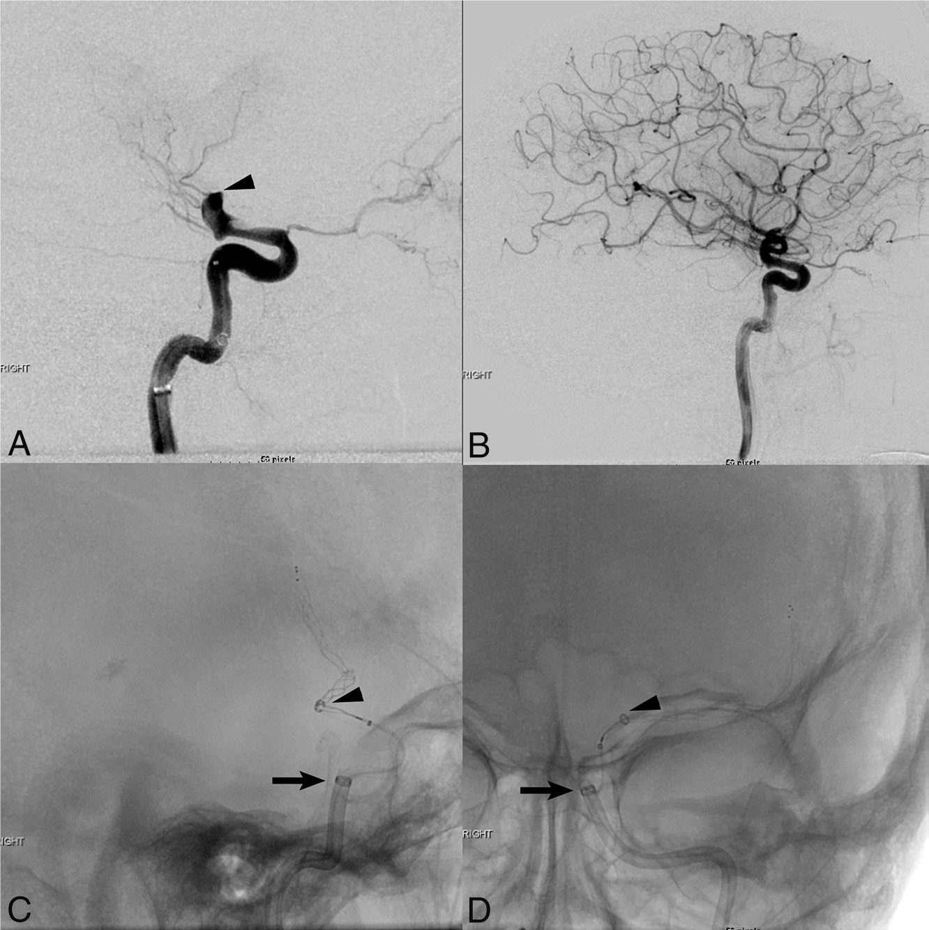 GUARD技术可提高再灌注率和预后 - 脑医汇