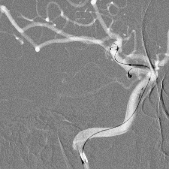 Prime一刻 | 刘赫教授栓塞破裂动脉瘤病例分享 - 脑医汇