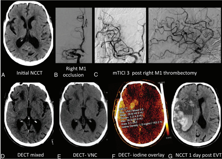 急性脑卒中患者再通术后出血的预测：基于脑实质与上矢状窦碘浓度对比的双能CT改善了评估的准确性 - 脑医汇