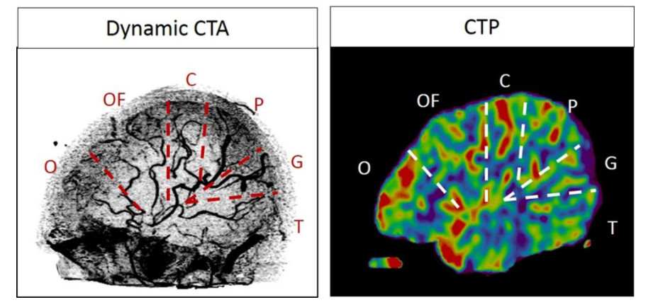 如何通过CTP来准确量化急性缺血性卒中后的侧支循环？ - 脑医汇