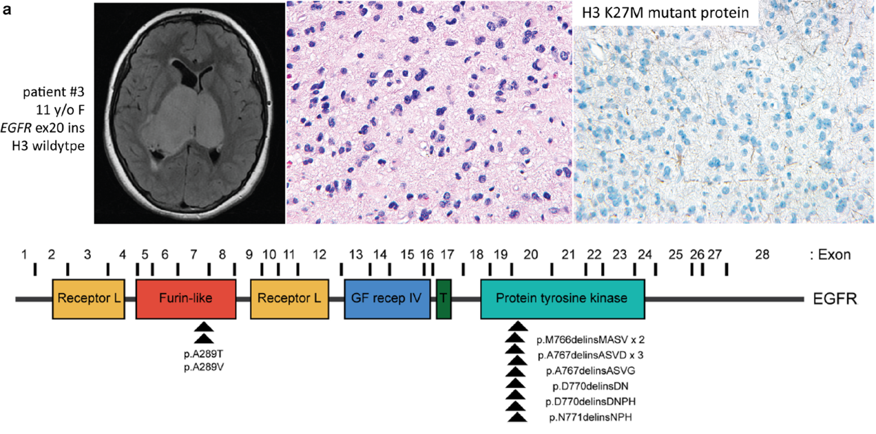 EGFR 20号外显子插入突变——儿童双侧丘脑胶质瘤分子标志物 - 脑医汇 - 神外资讯 - 神介资讯