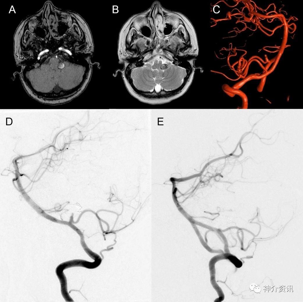 治疗复杂后循环病变——双侧桡动脉入路可行！ - 脑医汇
