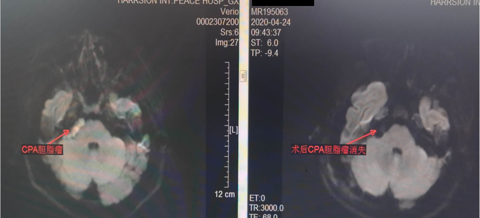 毛建辉主任医师：多种因素导致三叉神经痛手术体会 - 脑医汇