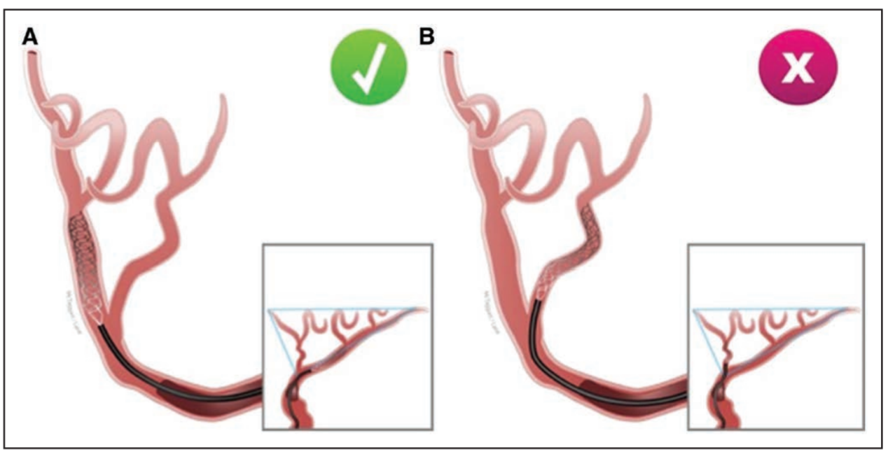 STROKE重点更新-如何实现快速eTICI 2c-3级再通 - 脑医汇