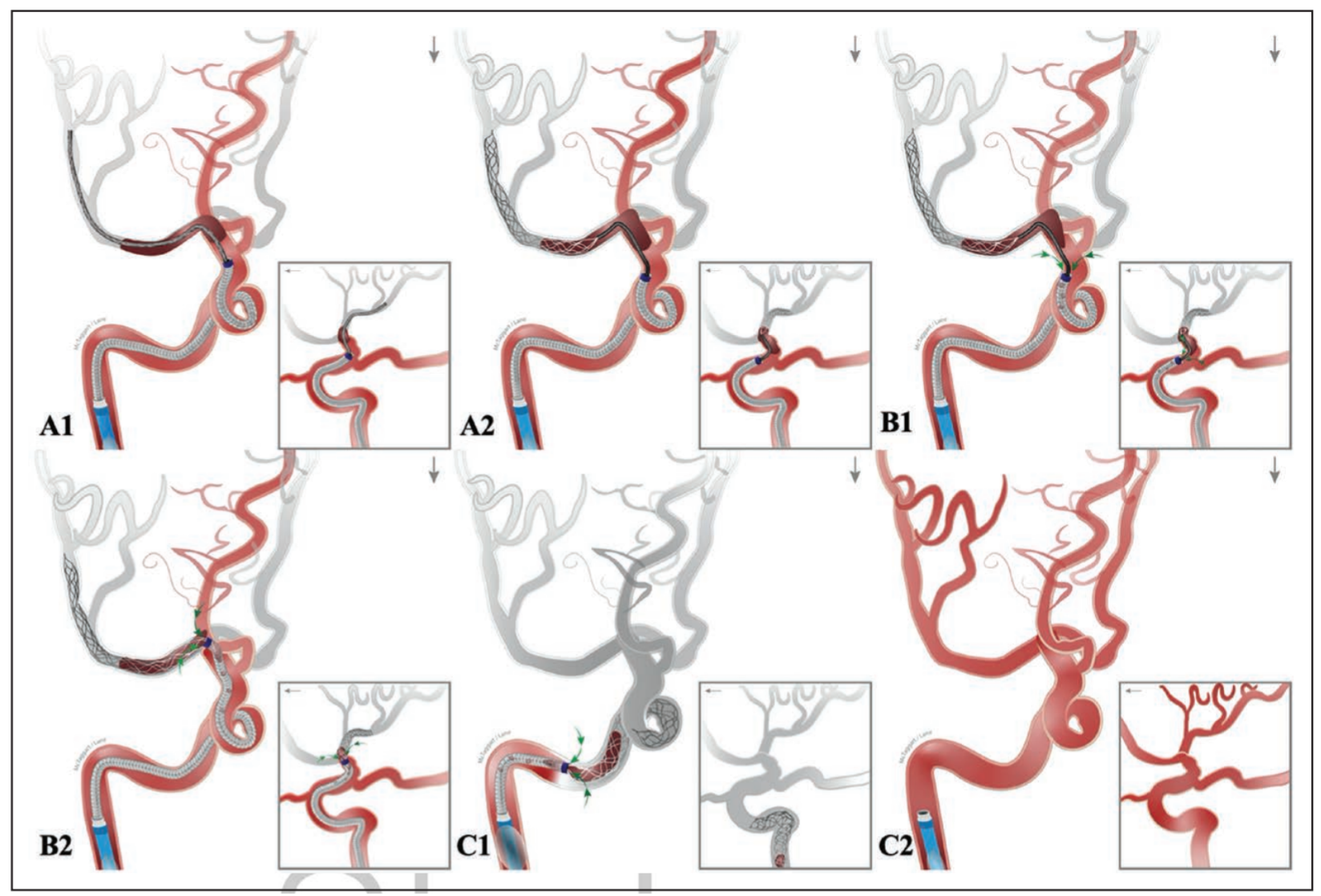 STROKE重点更新-如何实现快速eTICI 2c-3级再通 - 脑医汇
