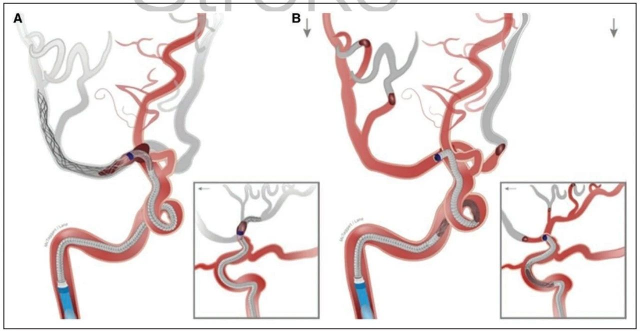 STROKE重点更新-如何实现快速eTICI 2c-3级再通 - 脑医汇