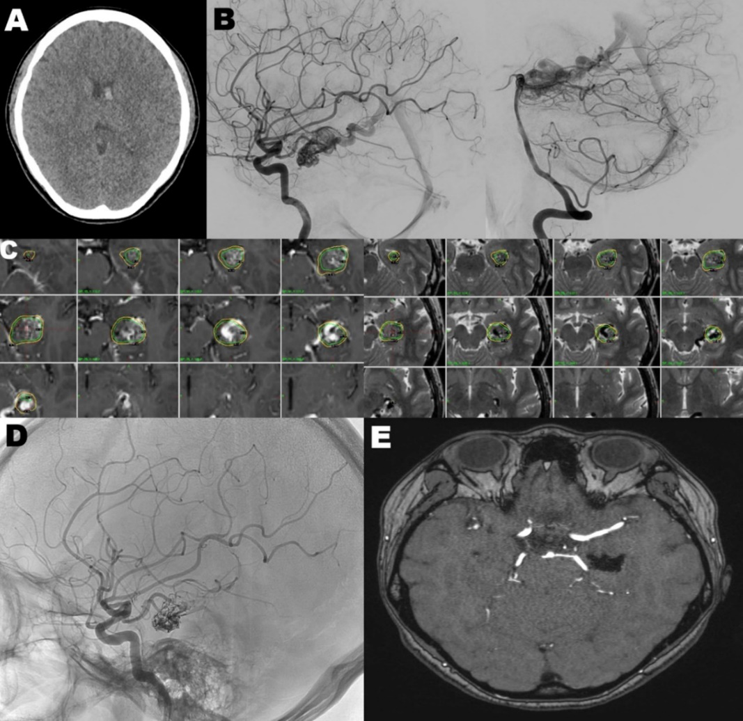 AVM出血后伽马刀放射外科治疗桥接介入栓塞的可行性探讨 - 脑医汇