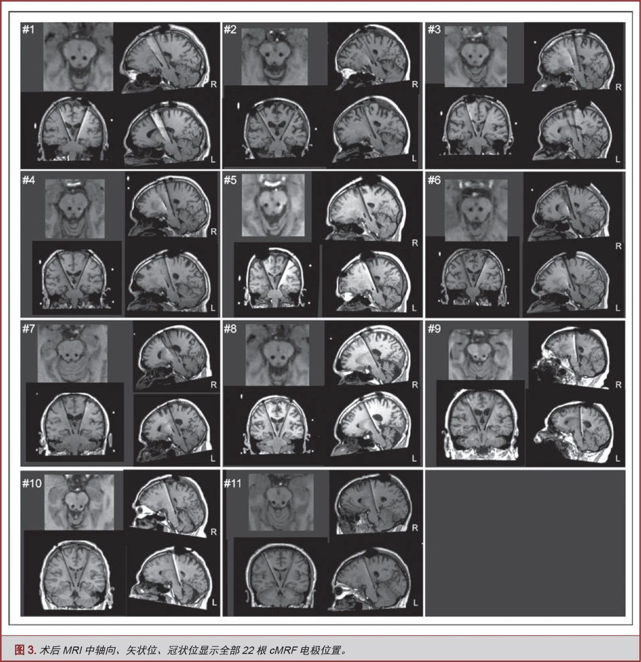 脚桥核电刺激治疗帕金森病：基于MRI的解剖临床关联分析及最优靶点选择丨《Neurosurgery》（中文版）脊柱脊髓与功能分册 - 脑医汇