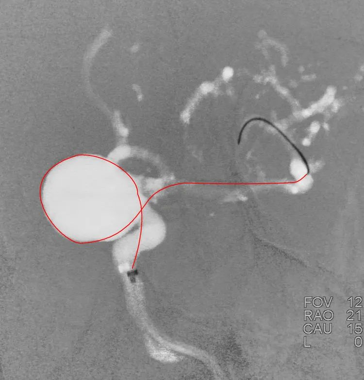 颅内动脉瘤栓塞时弹簧圈的选择——第六回 未破裂大型动脉瘤 - 脑医汇
