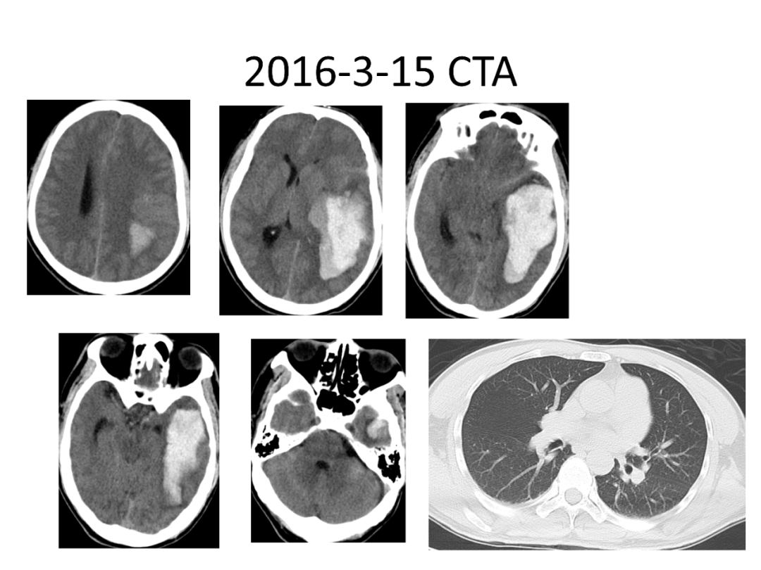 钟书教授专栏丨中枢重症第5期： 一例AVM出血术后神经重症处理（有关：镇静镇痛、感染性休克、 癫痫、低颅压脑疝等） - 脑医汇
