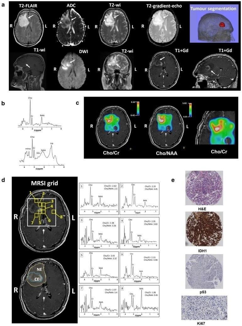 HGG的主要遗传差异表现为不同的MRI和MRS成像 - 脑医汇
