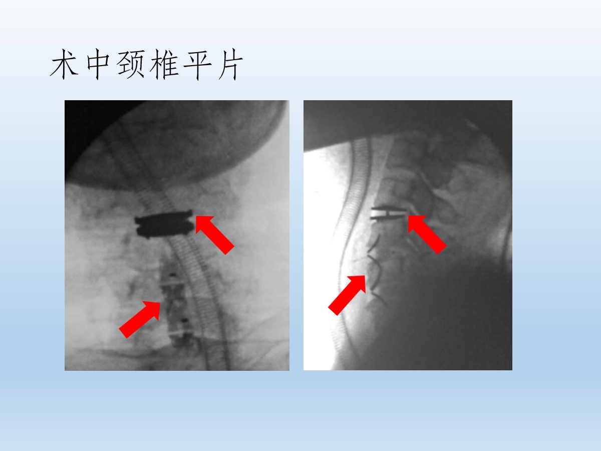 山西省首例显微镜下Hybird技术（间盘MOBI-C联合零切迹ROI-C）治疗多节段脊髓型颈椎病 - 脑医汇