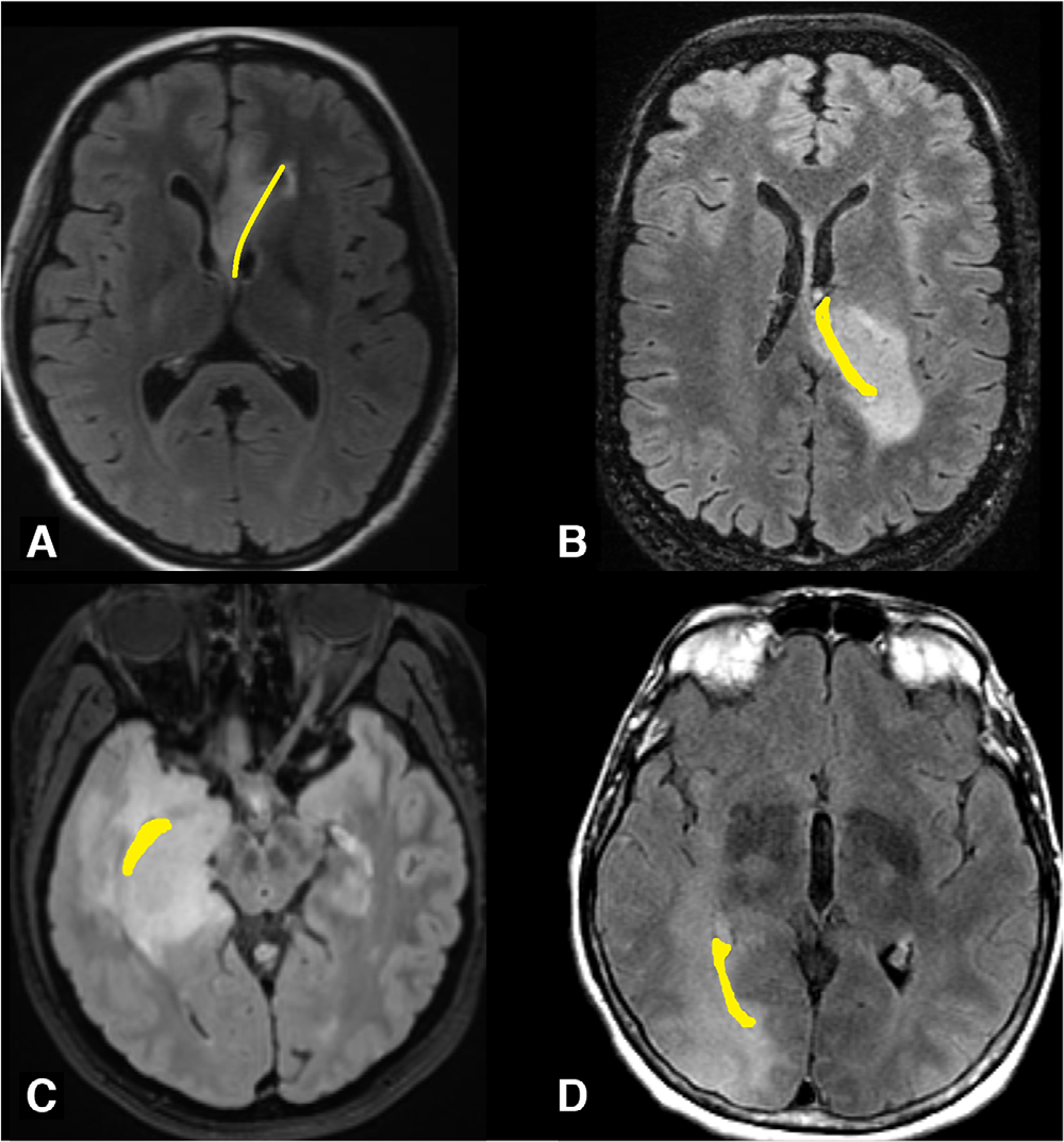 MRI显示SVZ受侵犯结合肿瘤基因组学判断LGG预后 - 脑医汇