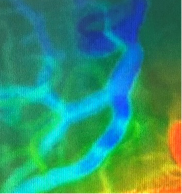 徐斌教授丨聊聊与搭桥相关的血流动力学那些事（二） - 脑医汇