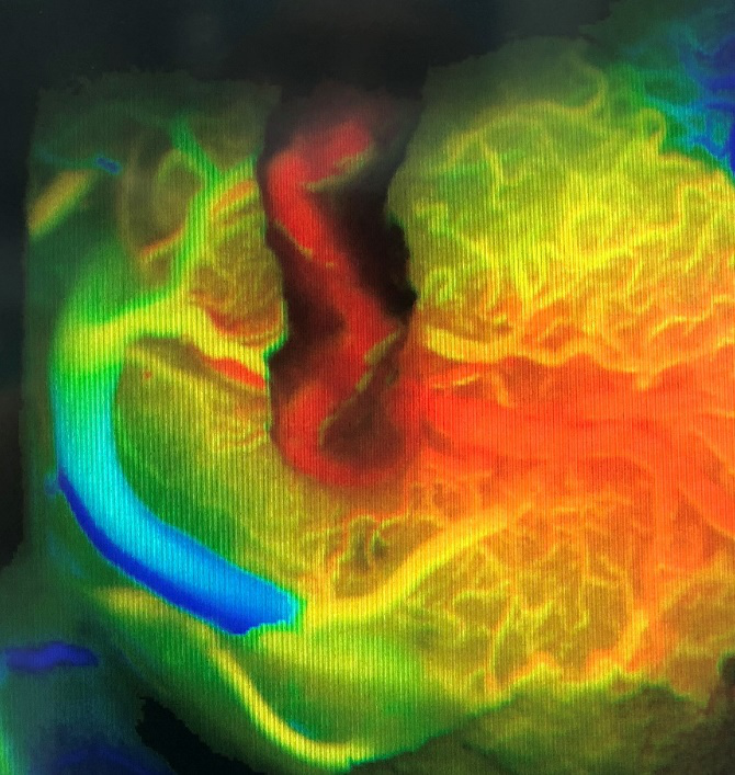 徐斌教授丨聊聊与搭桥相关的血流动力学那些事（二） - 脑医汇