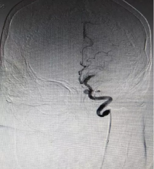 神畅视介丨利用stryker AXS Catalyst导管及Neuro RX球囊完成大脑中动脉急性闭塞支架取栓（颈内动脉严重迂曲） - 脑医汇