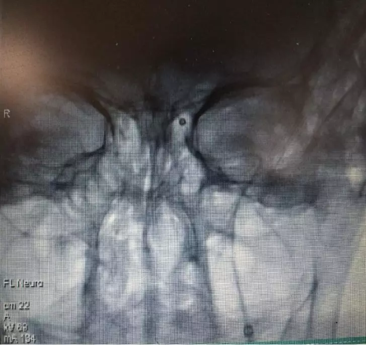 神畅视介丨利用stryker AXS Catalyst导管及Neuro RX球囊完成大脑中动脉急性闭塞支架取栓（颈内动脉严重迂曲） - 脑医汇