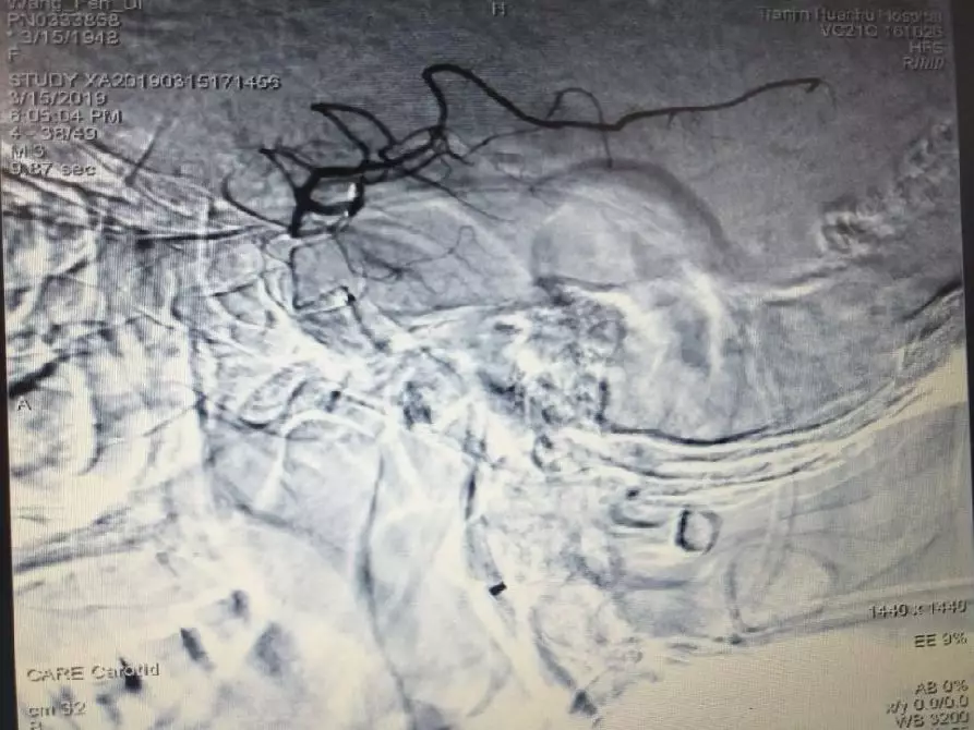 神畅视介丨利用stryker AXS Catalyst导管及Neuro RX球囊完成大脑中动脉急性闭塞支架取栓（颈内动脉严重迂曲） - 脑医汇