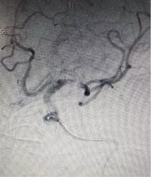 神畅视介丨利用stryker AXS Catalyst导管及Neuro RX球囊完成大脑中动脉急性闭塞支架取栓（颈内动脉严重迂曲） - 脑医汇