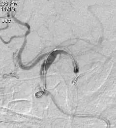 神畅视介丨利用stryker AXS Catalyst导管及Neuro RX球囊完成大脑中动脉急性闭塞支架取栓（颈内动脉严重迂曲） - 脑医汇
