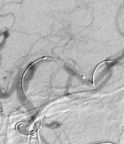 利用stryker AXS Catalyst导管及Neuro RX球囊完成大脑中动脉急性闭塞支架取栓（颈内动脉严重迂曲） - 脑医汇 - 神 ...