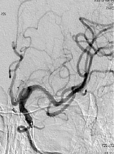 神畅视介丨利用stryker AXS Catalyst导管及Neuro RX球囊完成大脑中动脉急性闭塞支架取栓（颈内动脉严重迂曲） - 脑医汇