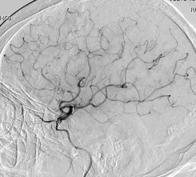 神畅视介丨利用stryker AXS Catalyst导管及Neuro RX球囊完成大脑中动脉急性闭塞支架取栓（颈内动脉严重迂曲） - 脑医汇