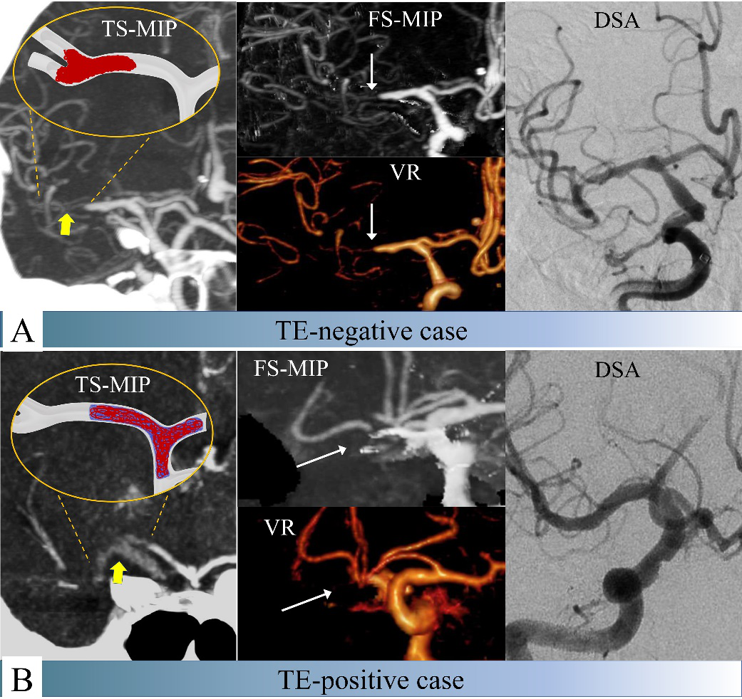 上海市第六人民医院放射介入科团队 研究CTA薄层MIP检测血栓强化征象在急性脑卒中的应用最新成果 - 脑医汇