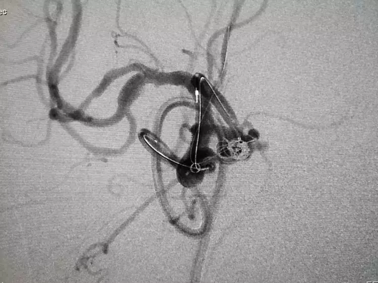 威视课堂第四期丨Scepter球囊结合Target 360弹簧圈治疗分支受累破裂前交通动脉瘤 - 脑医汇