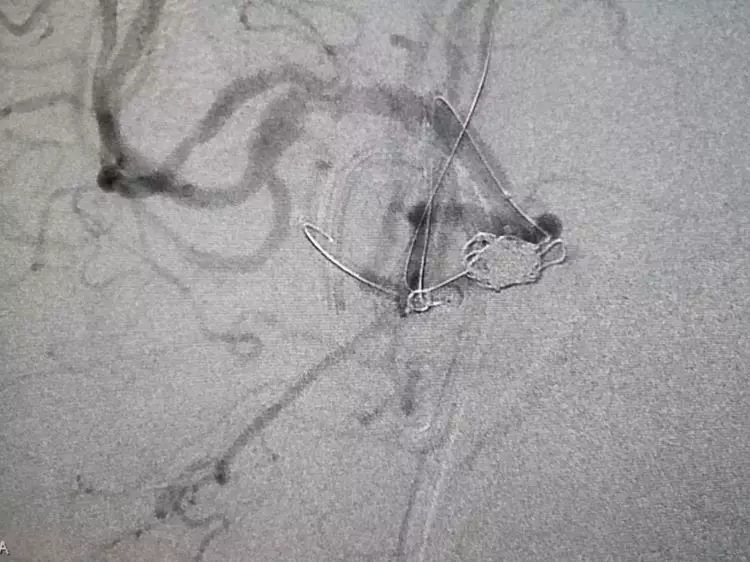 威视课堂第四期丨Scepter球囊结合Target 360弹簧圈治疗分支受累破裂前交通动脉瘤 - 脑医汇