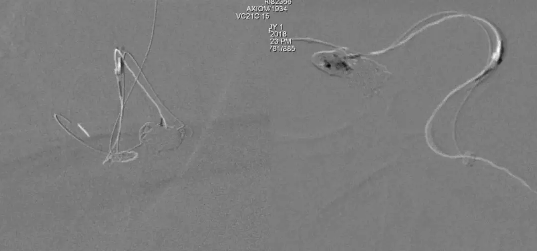 威视课堂第四期丨Scepter球囊结合Target 360弹簧圈治疗分支受累破裂前交通动脉瘤 - 脑医汇