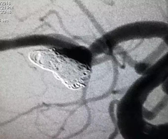 威视课堂第四期丨Scepter球囊结合Target 360弹簧圈治疗分支受累破裂前交通动脉瘤 - 脑医汇