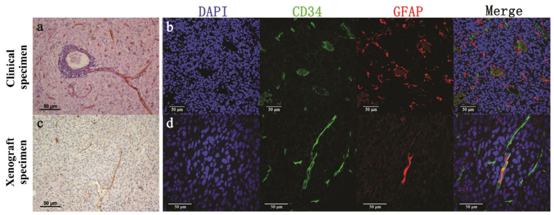 肿瘤细胞来源血管与胶质母细胞瘤患者预后的关系 - 脑医汇