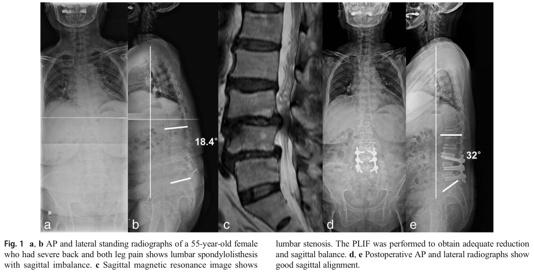 OLIF治疗腰椎退变性滑脱伴矢状面失衡的疗效及影像学分析 - 脑医汇 - 神外资讯 - 神介资讯
