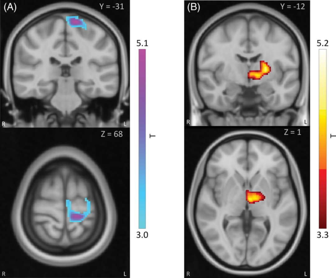 静息态功能连接预测STN-DBS治疗PD的临床效果 - 脑医汇